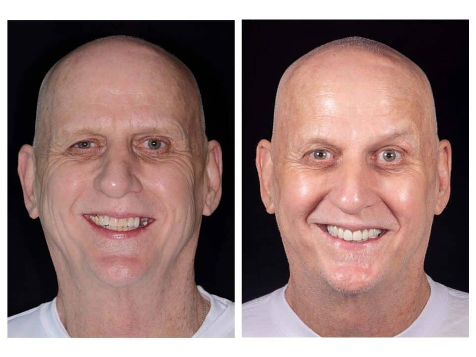 Smile Gallery - Prosthodontist Knoxville, TN - Derrick Thomas, DDS